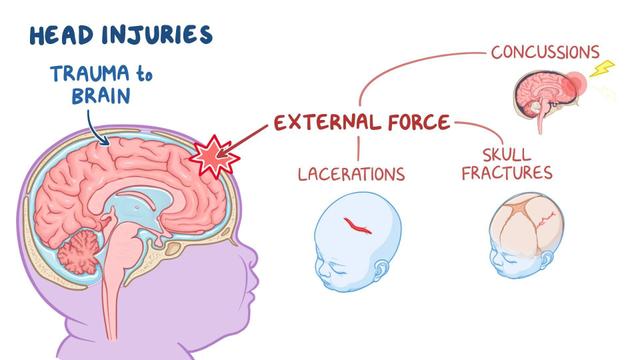 Head injury - Pediatric: Nursing: Vídeo & Anatomía | Osmosis