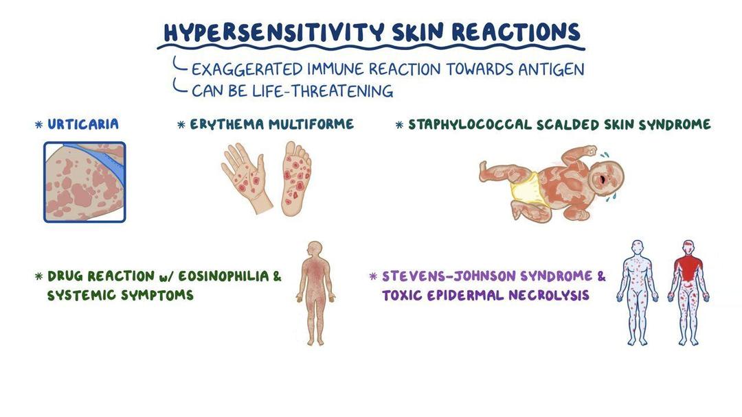 Hypersensitivity skin reactions: Clinical: Video, Causes, & Meaning ...