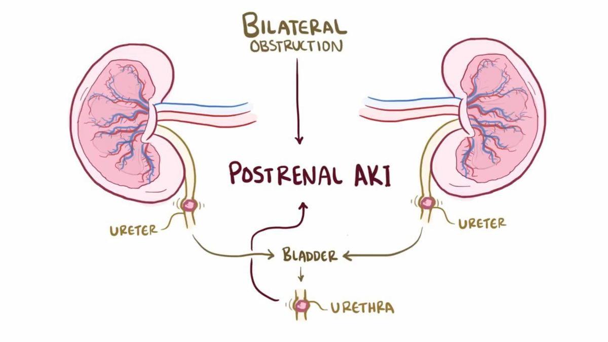 Postrenal azotemia: Video, Causes, & Meaning | Osmosis