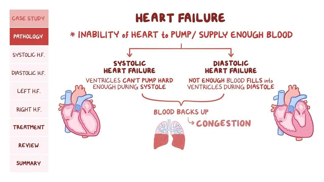Heart failure: Pathology review: Video, Causes, & Meaning | Osmosis