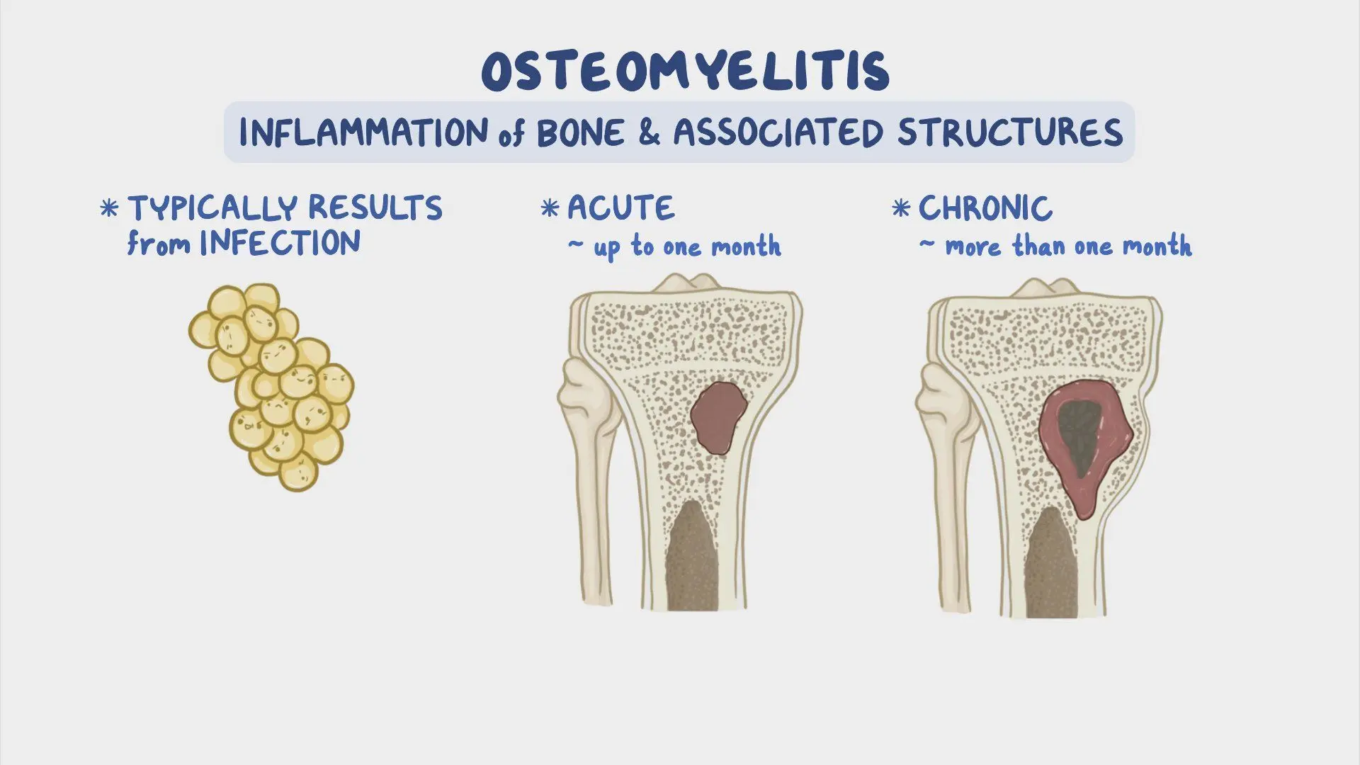 Osteomyelitis: Nursing: Video & Causes | Osmosis