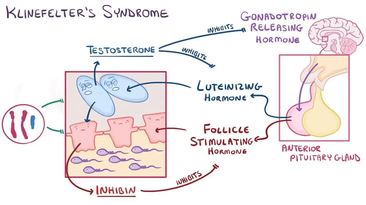 Klinefelter syndrome: Video, Causes, & Meaning | Osmosis