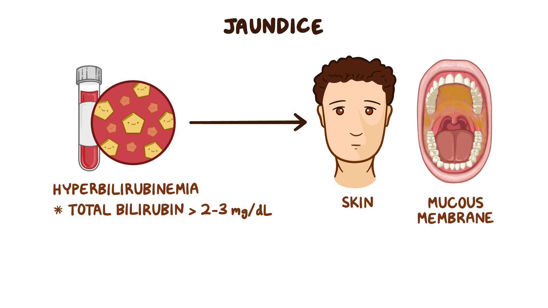 Approach to jaundice (conjugated hyperbilirubinemia): Video & Meaning ...