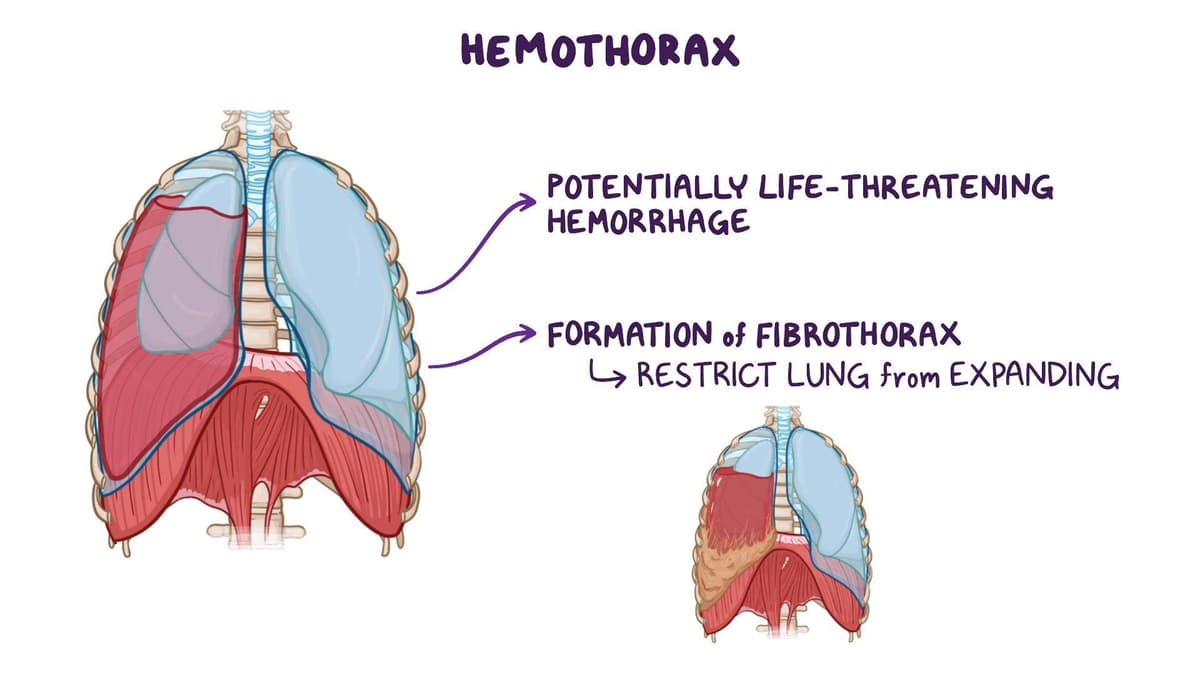 Hemothorax Clinical Sciences Osmosis Video Library