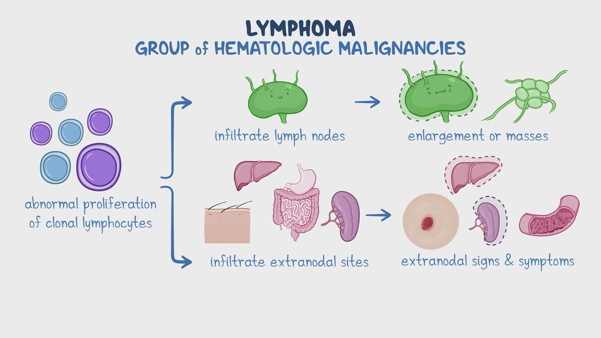 Approach to lymphoma: Video & Meaning | Osmosis