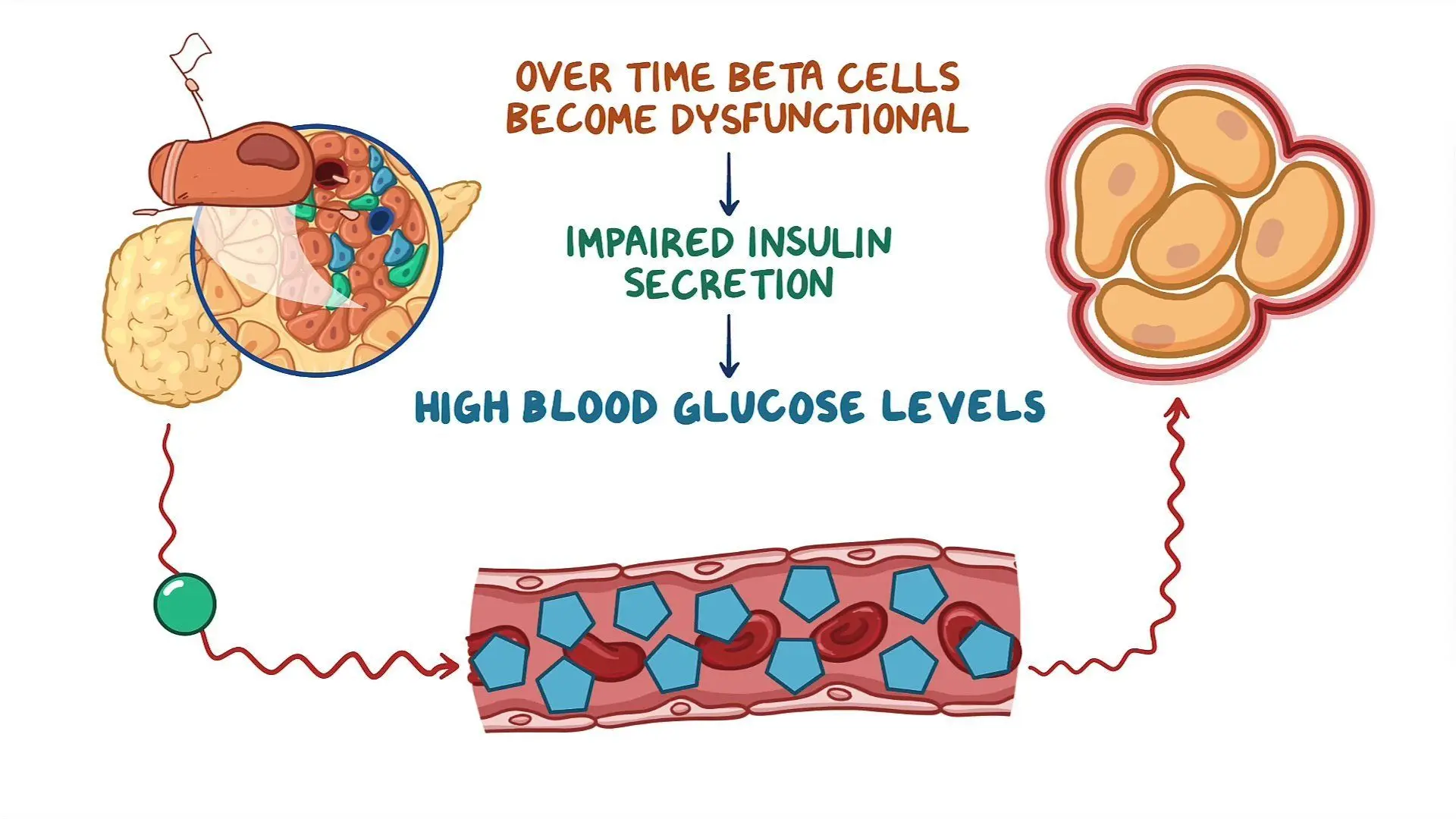 Diabetes mellitus (Type 2): Video & Meaning | Osmosis