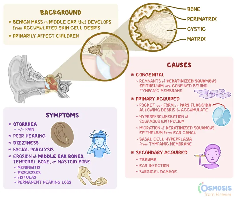 Cholesteatoma: What It Is, Causes, Signs, Symptoms, Diagnosis | Osmosis
