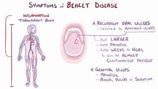 Vasculitis Notes: Diagrams & Download PDF | Osmosis