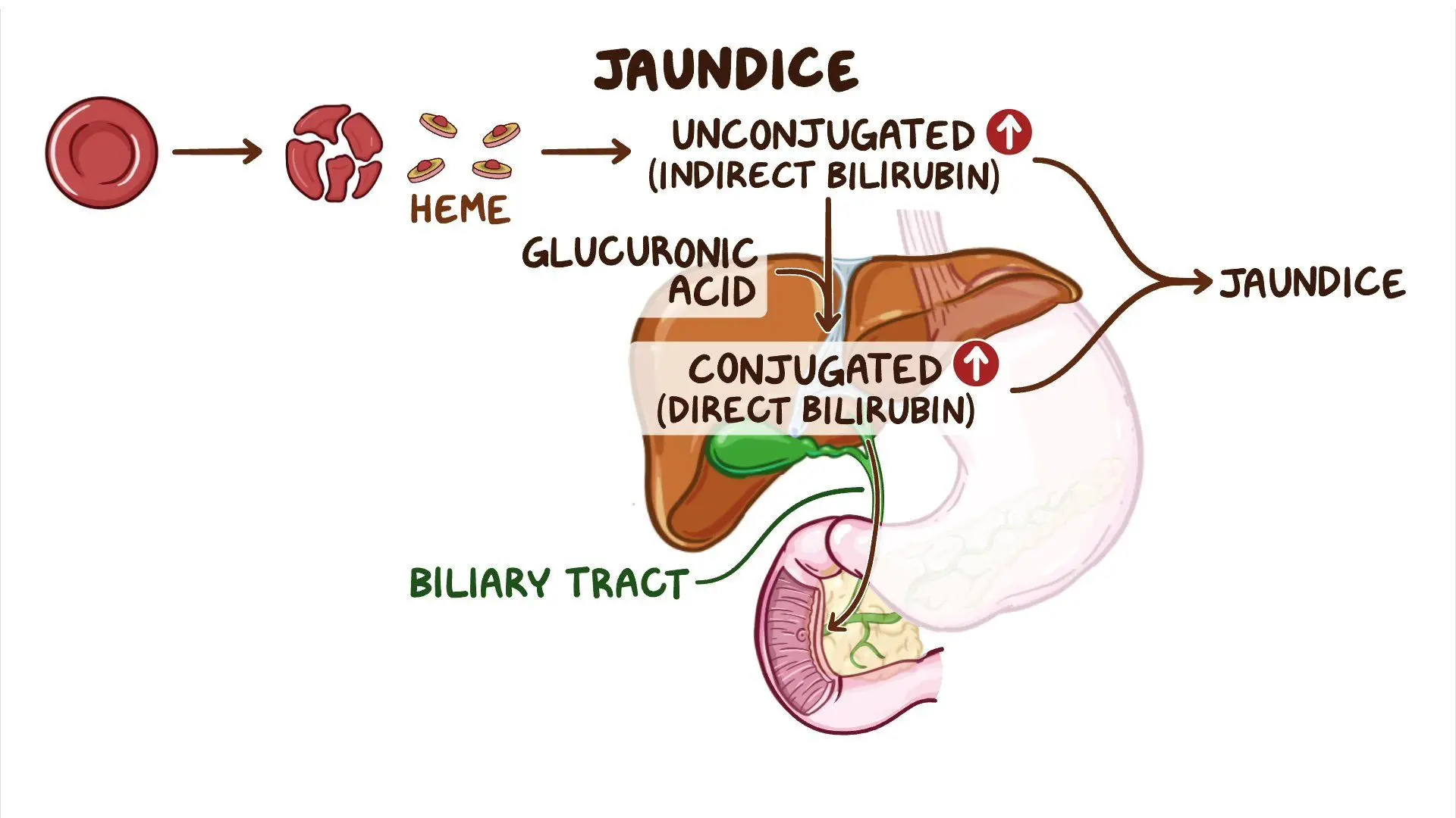 Approach to jaundice (unconjugated hyperbilirubinemia): Video & Meaning ...