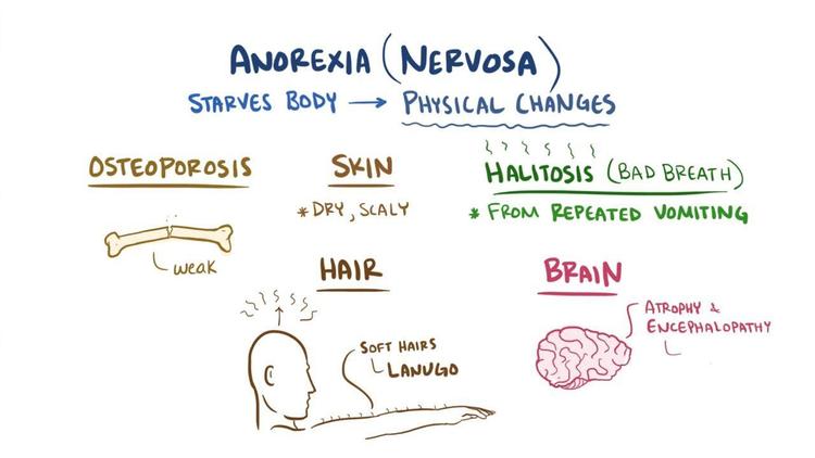 Anorexia nerviosa: Vídeo, Anatomía & Definición | Osmosis