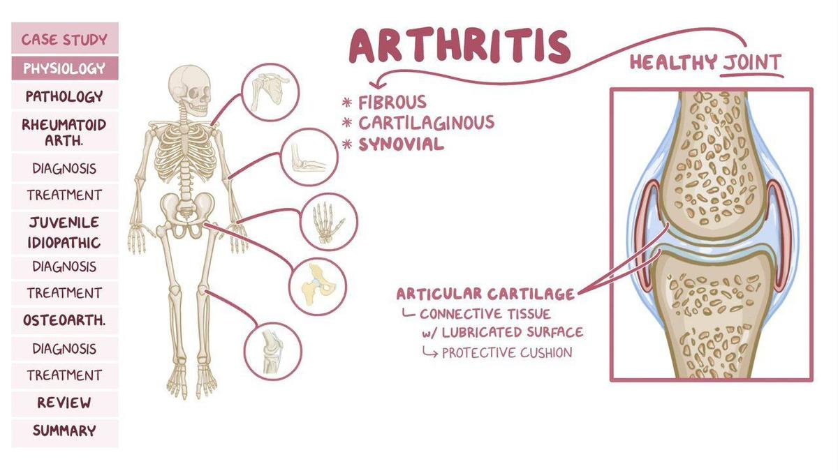 Rheumatoid arthritis and osteoarthritis: Pathology review: Video ...