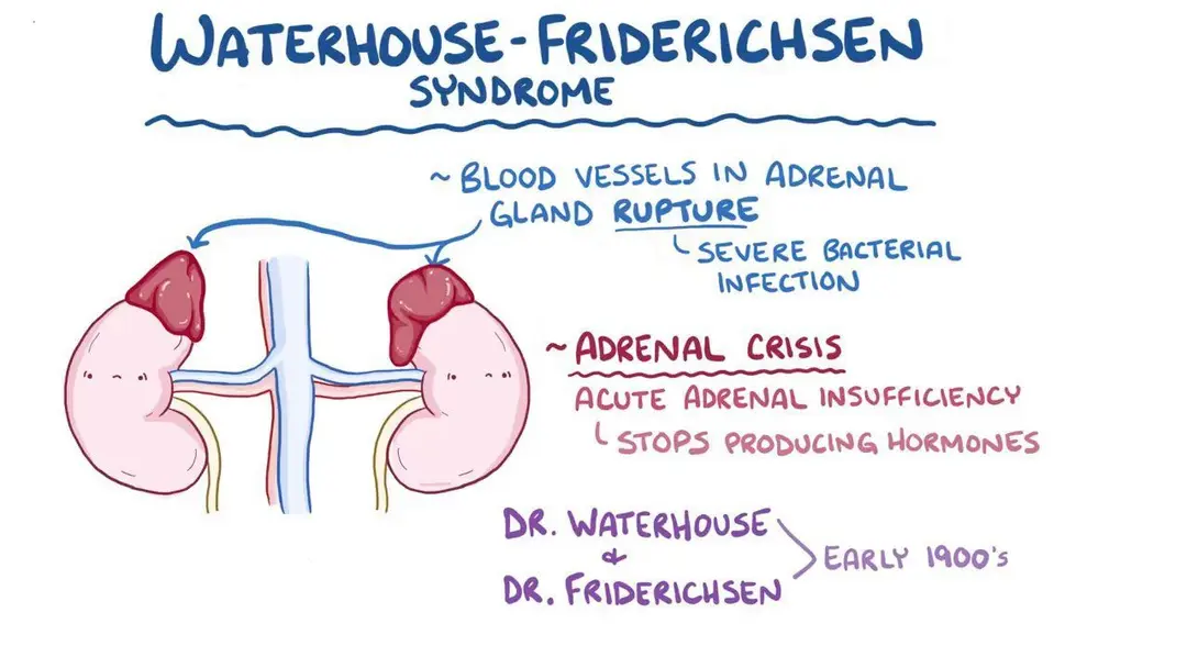 Síndrome de Waterhouse-Friderichsen: Vídeo & Anatomía | Osmosis