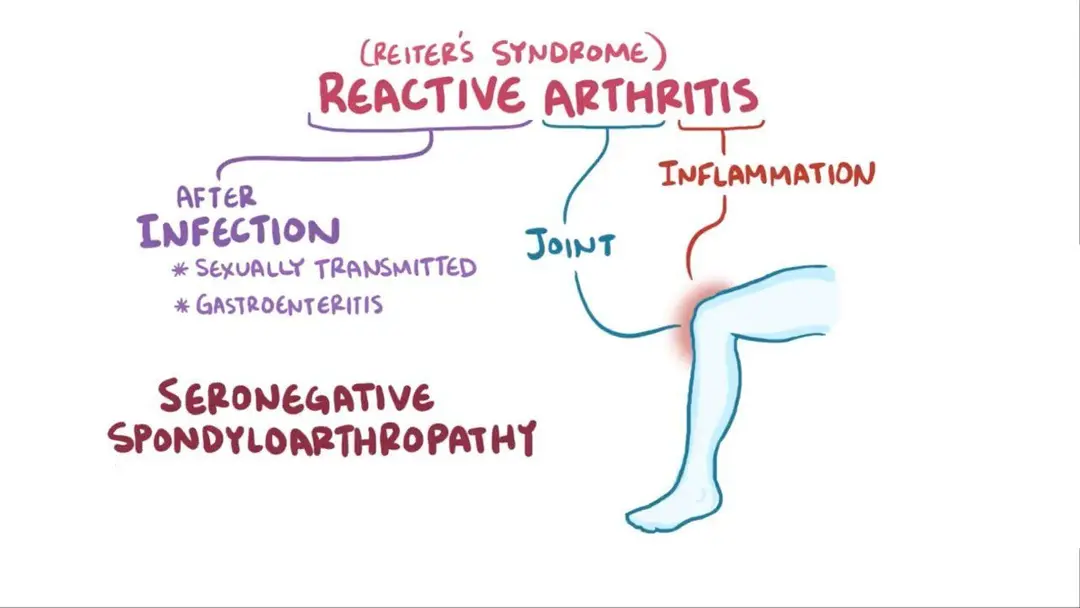 Reactive arthritis: Video, Anatomy & Definition | Osmosis