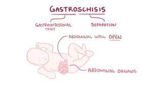 Lower gastrointestinal congenital malformations Notes: Diagrams ...