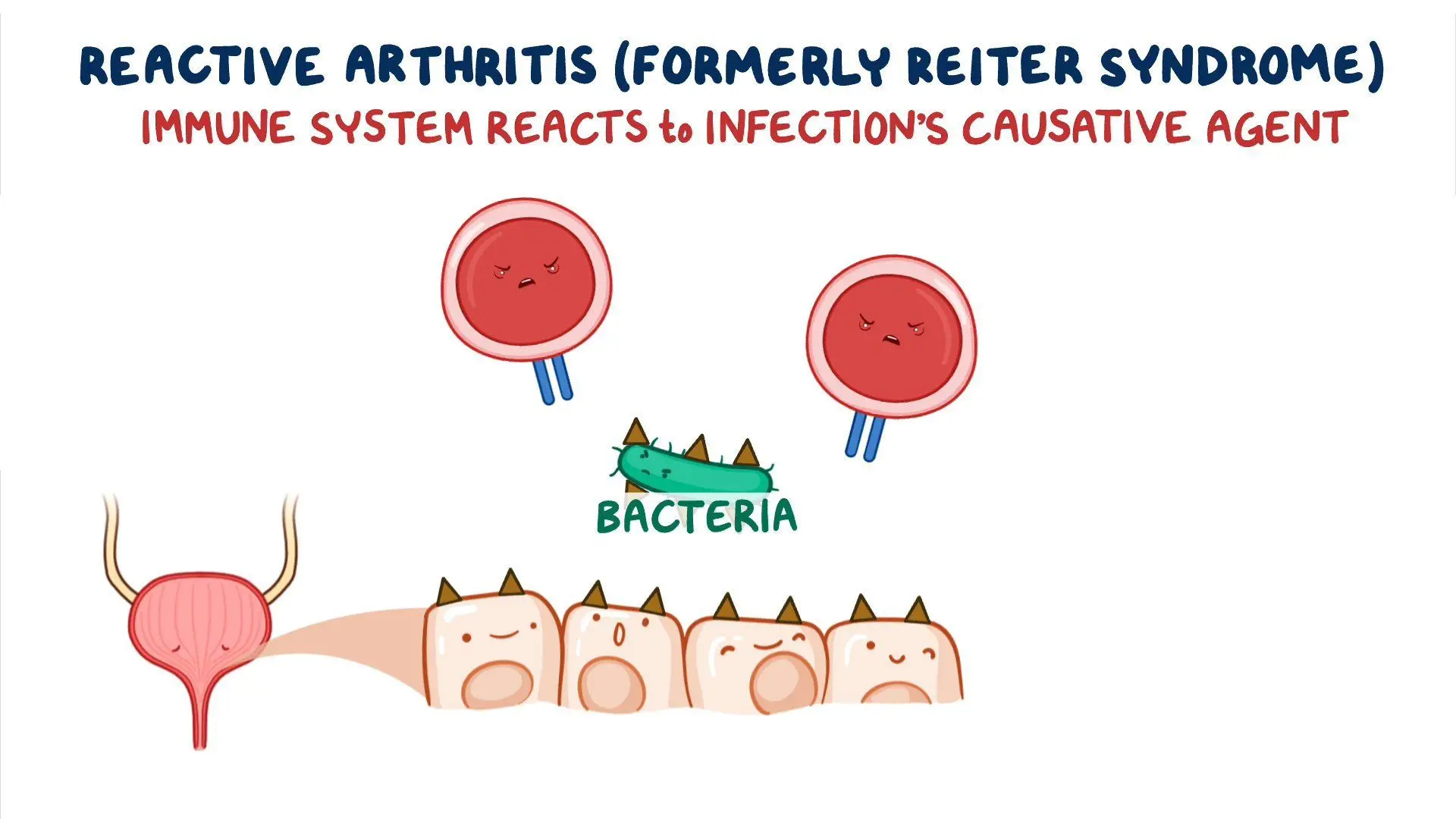 Reiter syndrome: Video & Causes | Osmosis