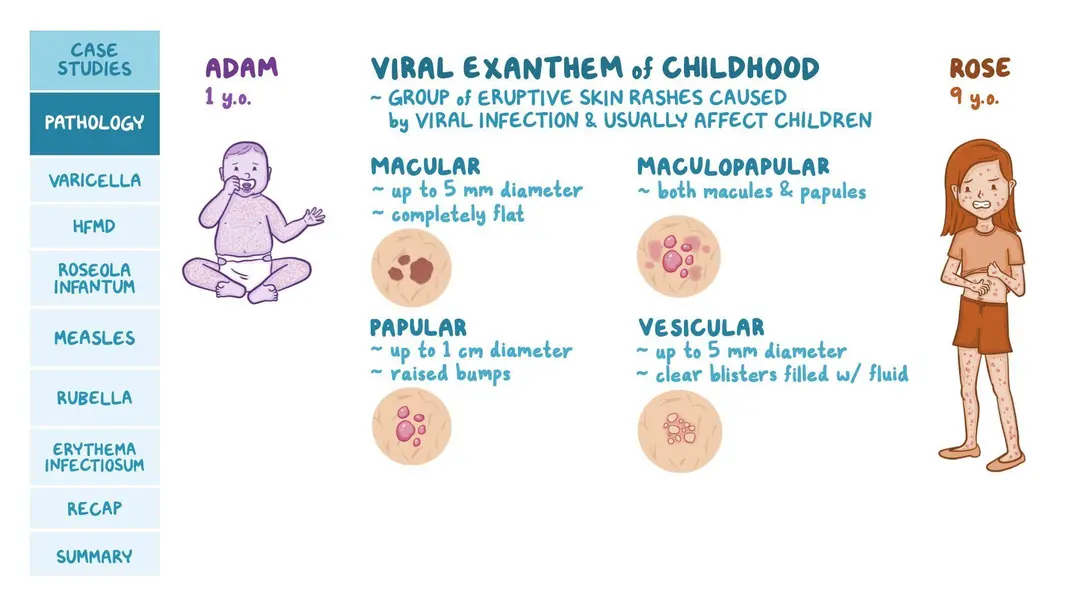 Viral exanthems of childhood: Pathology review: Video, Causes ...