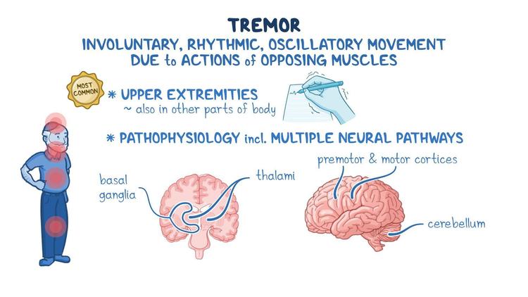 Approach to tremor: Video & Meaning | Osmosis