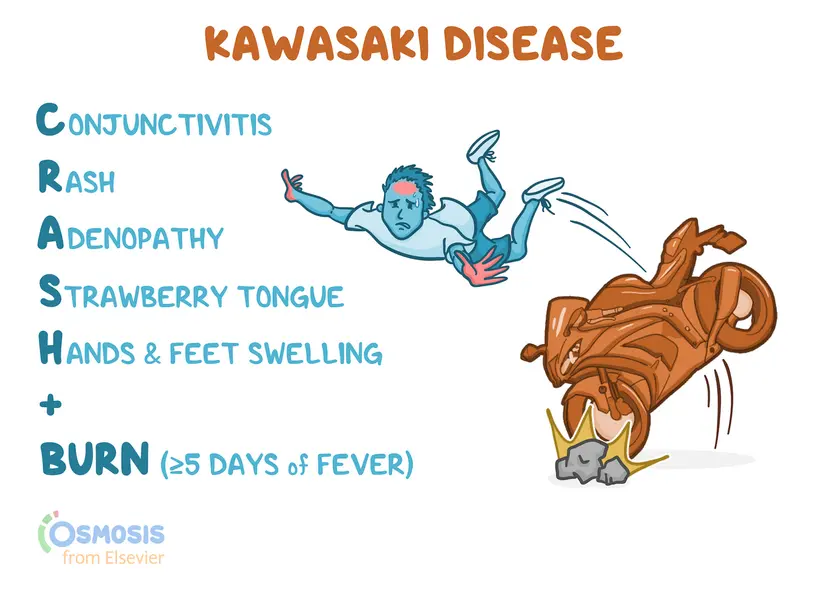 CRASH and Burn: Kawasaki Disease Signs and Symptoms Acronym | Osmosis