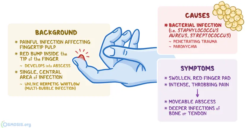 Felon Finger: What Is It, Causes, Appearance, Diagnosis, Treatment ...