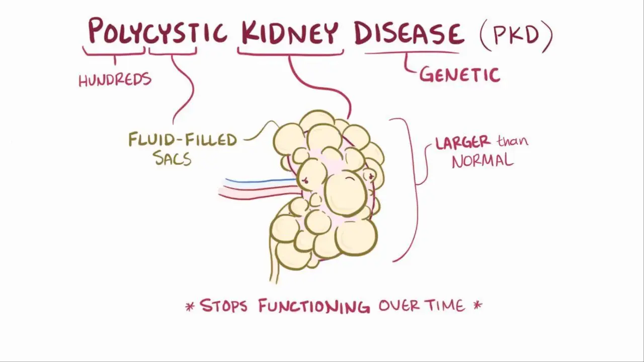Polycystic kidney disease: Video, Causes, & Meaning | Osmosis