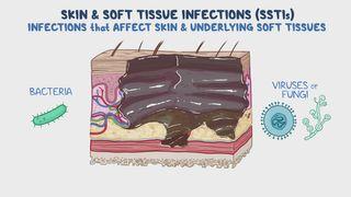 Yaws Disease: What It Is, Presentation, Treatment and More | Osmosis
