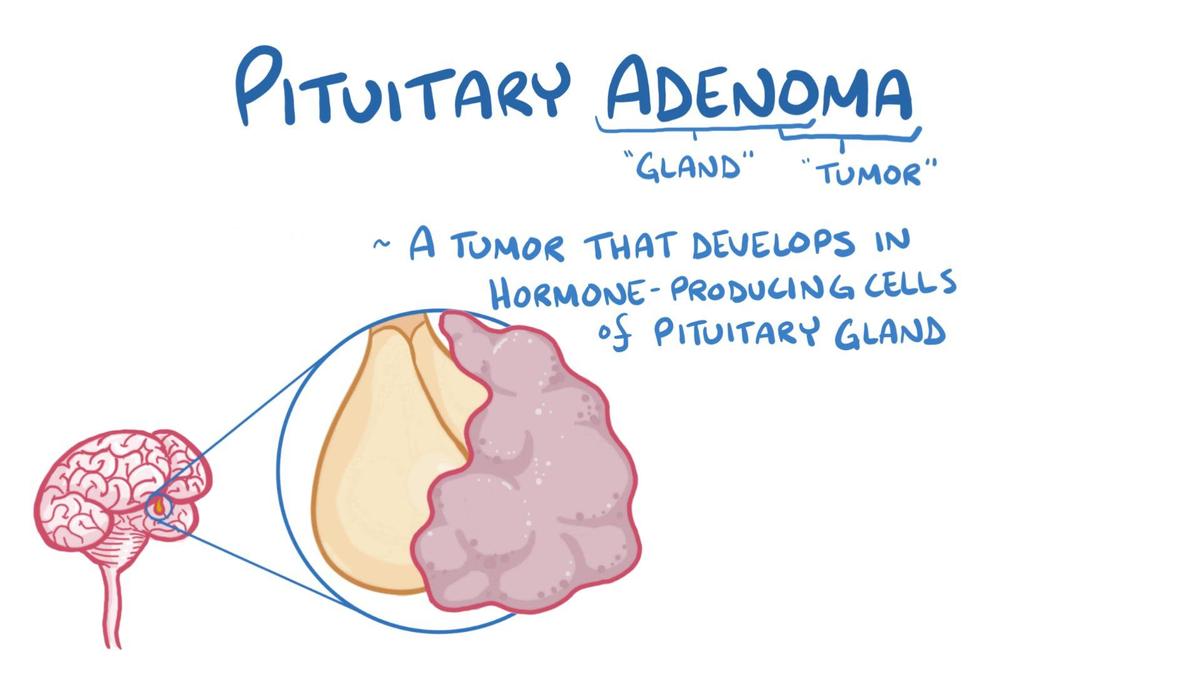 Pituitary adenoma: Video, Anatomy & Definition | Osmosis