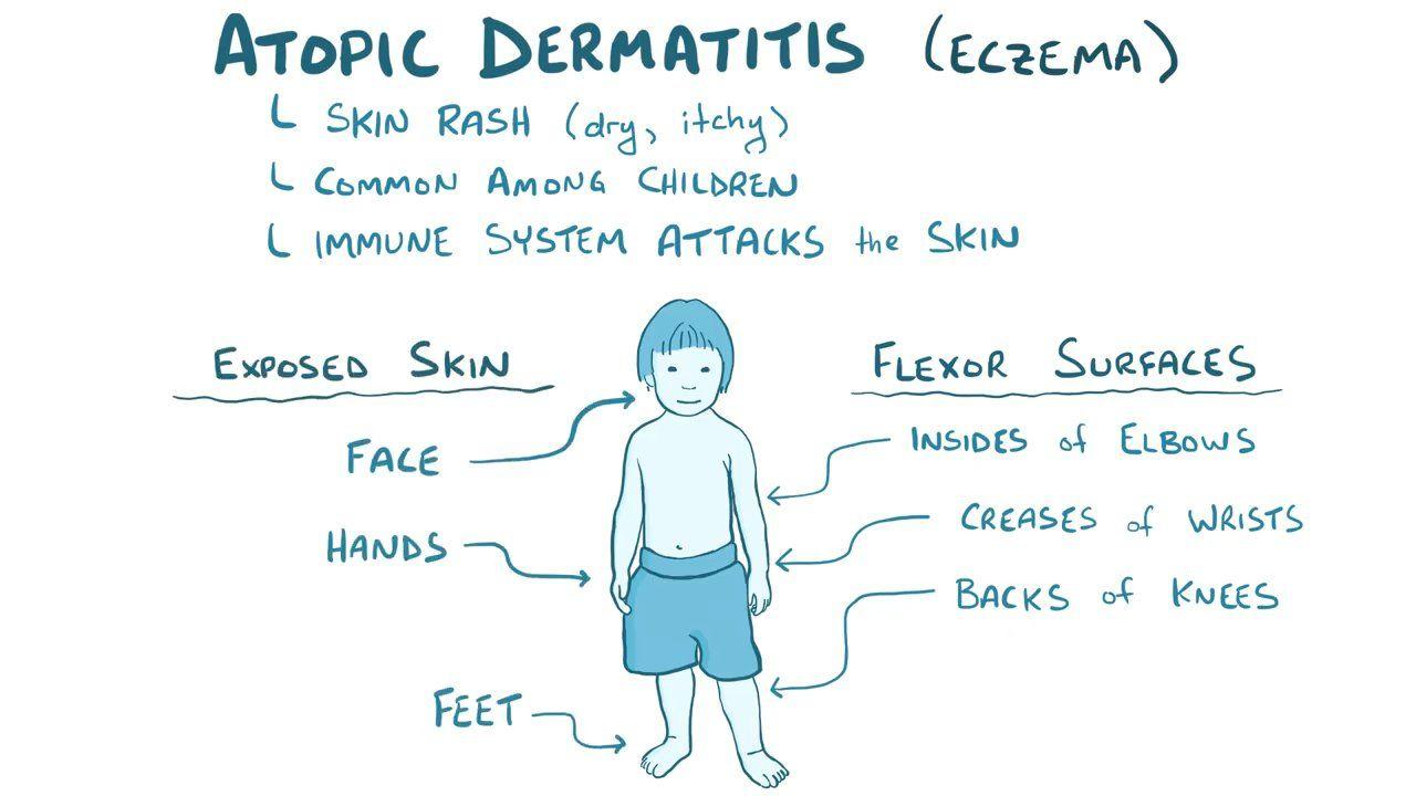 Dermatitis atópica: Vídeo, Anatomía & Definición | Osmosis