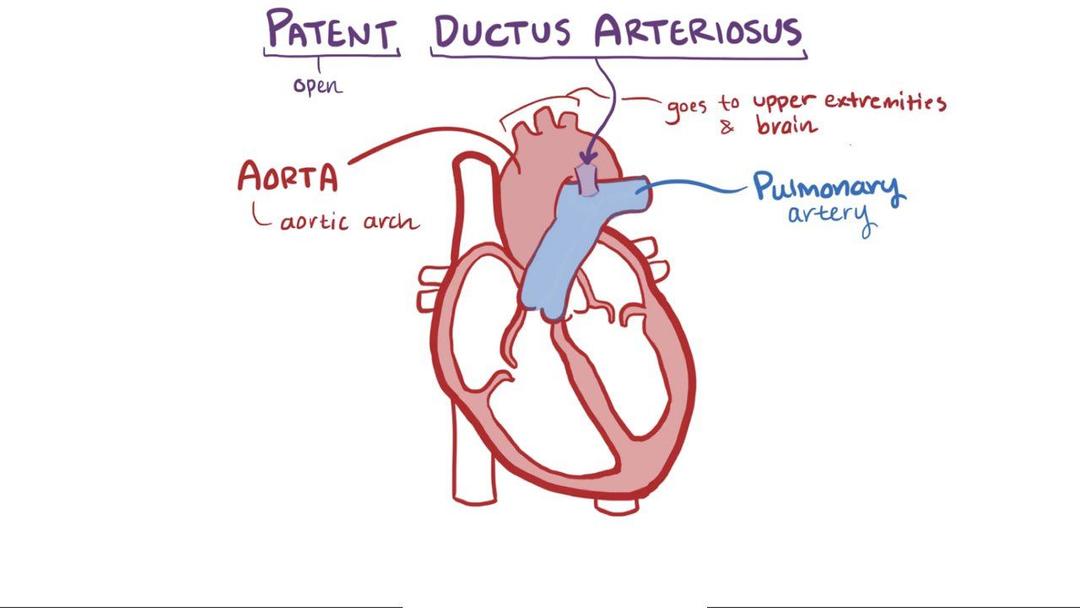 Patent ductus arteriosus: Video, Anatomy & Definition | Osmosis