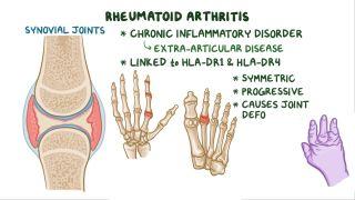 Felty Syndrome: What Is It, Causes, Symptoms | Osmosis