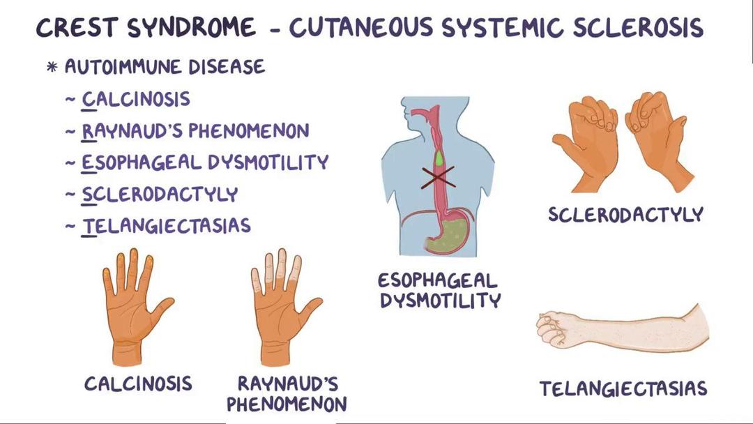 Limited systemic sclerosis (CREST syndrome): Vídeo | Osmosis