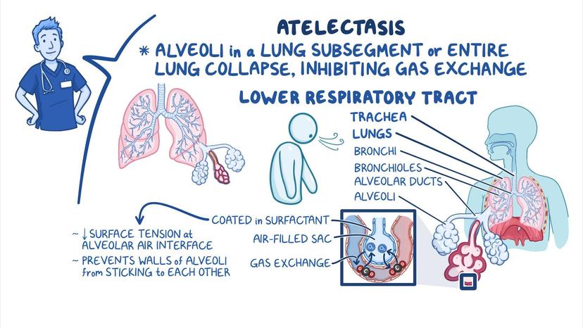 Atelectasis: Nursing - Osmosis Video Library