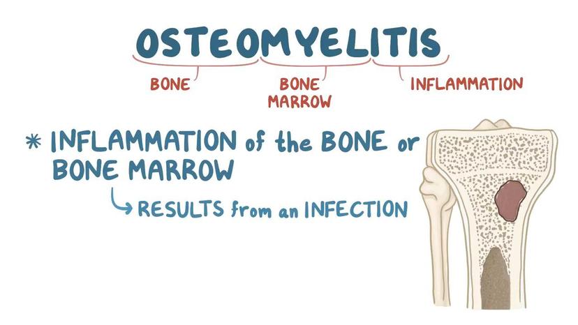 Osteomyelitis: Video, Anatomy, Definition & Function | Osmosis