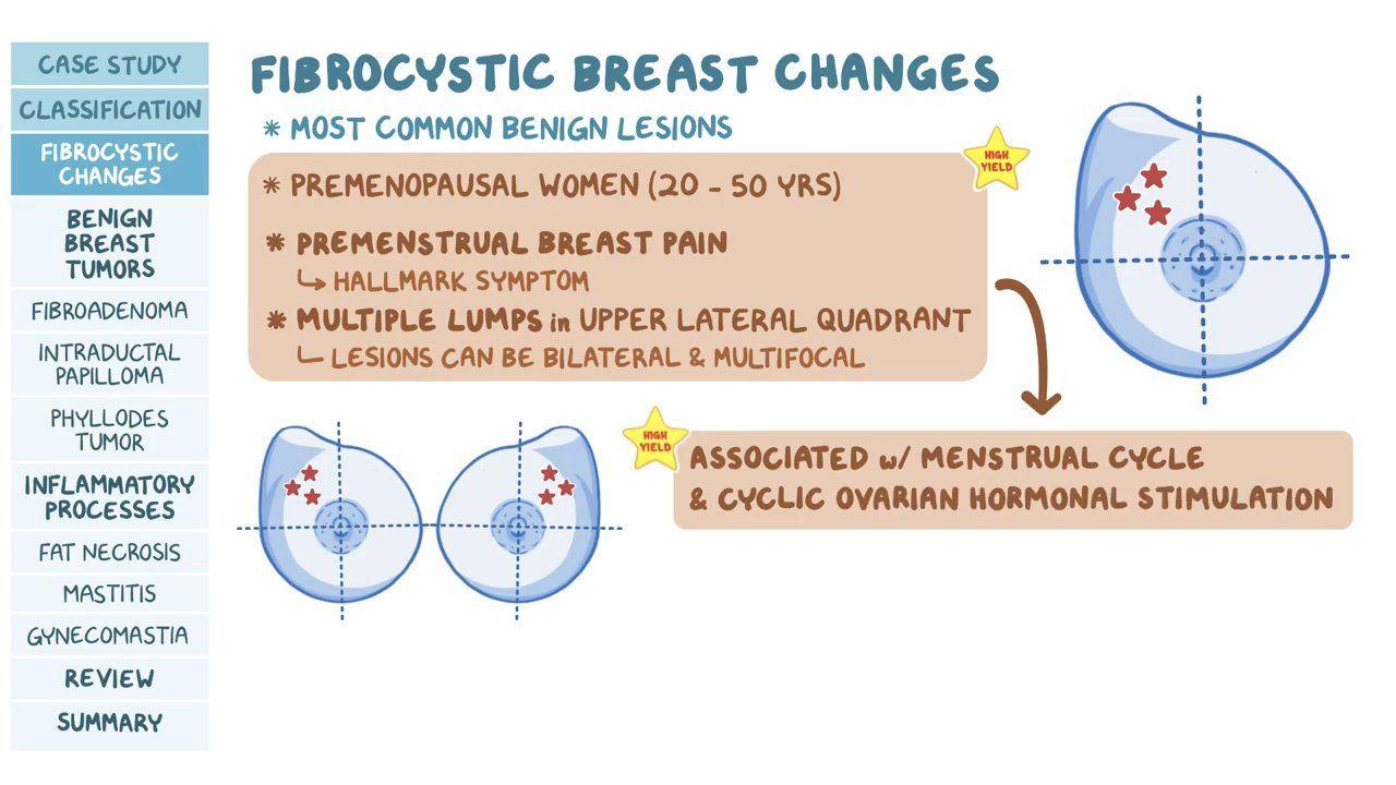 Benign breast conditions: Pathology review: Video | Osmosis