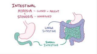 Choanal Atresia: What Is It, Causes | Osmosis