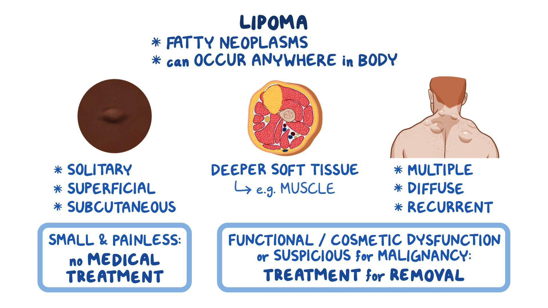 Lipoma: Clinical sciences - Osmosis Video Library