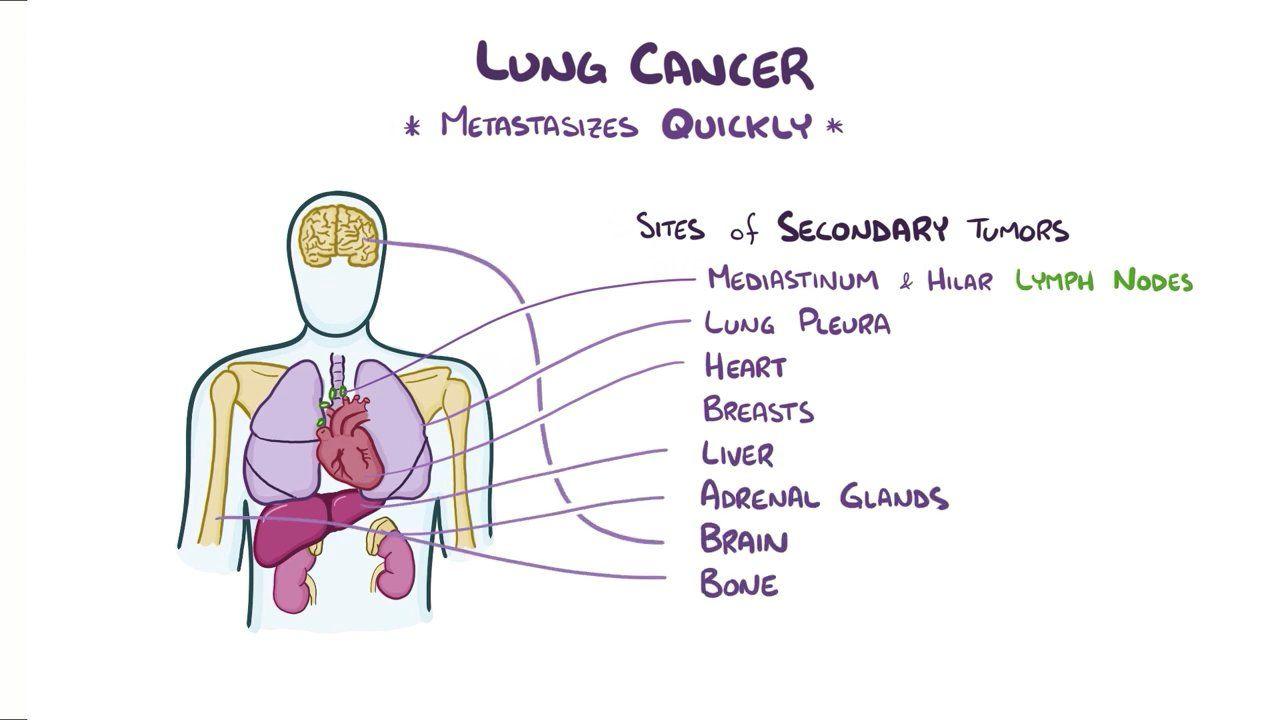 Lung cancer: Video, Anatomy, Definition & Function | Osmosis