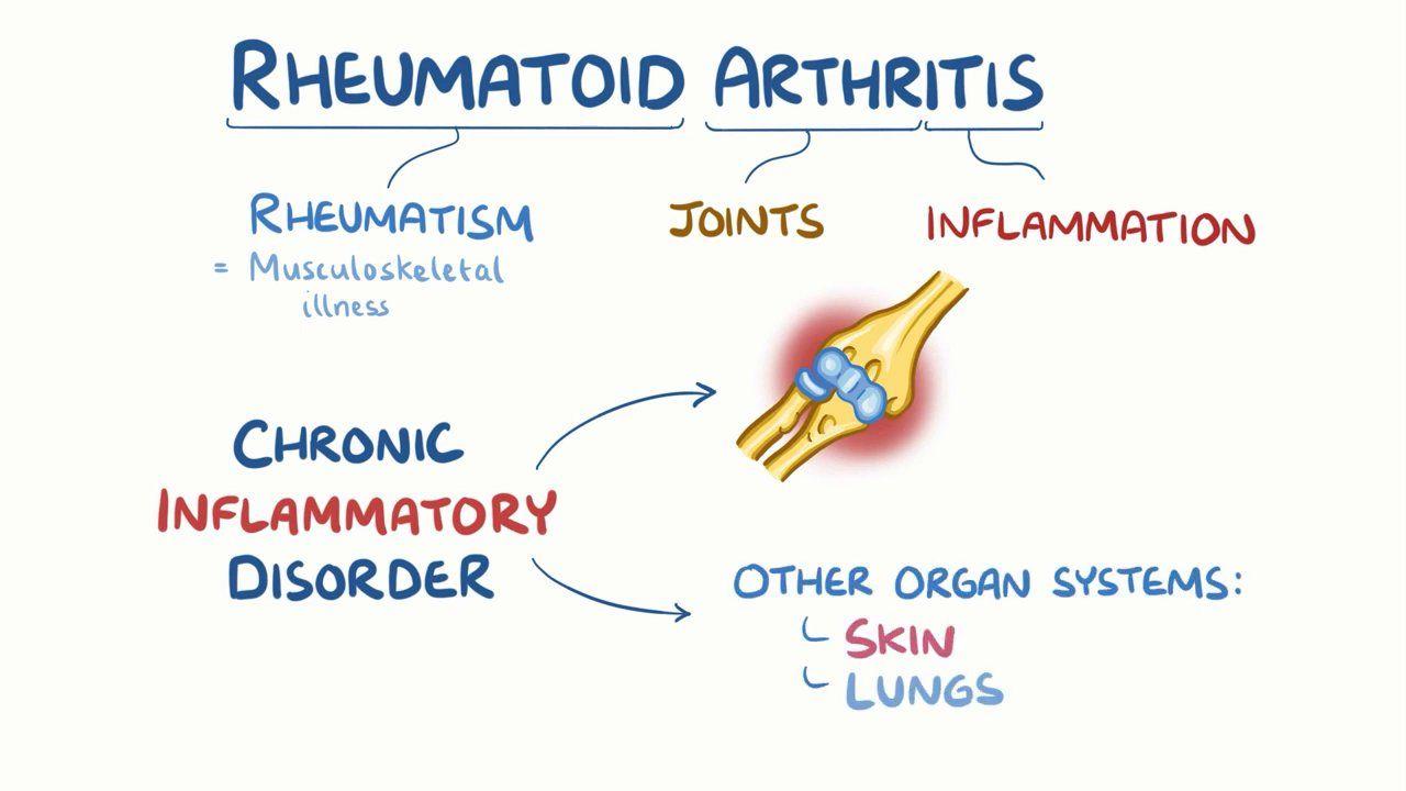 Rheumatoid arthritis: Video, Anatomy & Definition | Osmosis