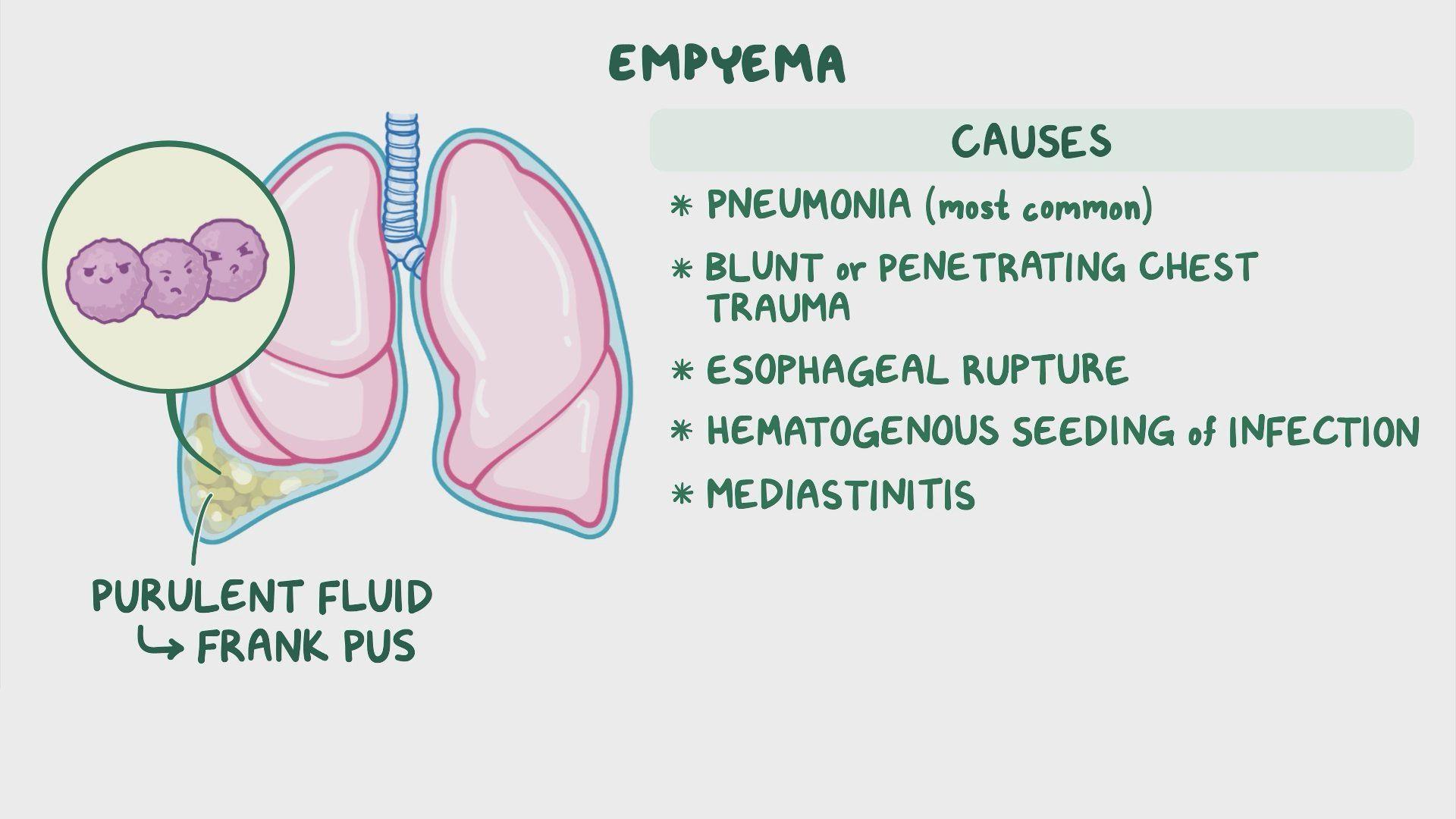 Empyema: Clinical sciences - Osmosis Video Library