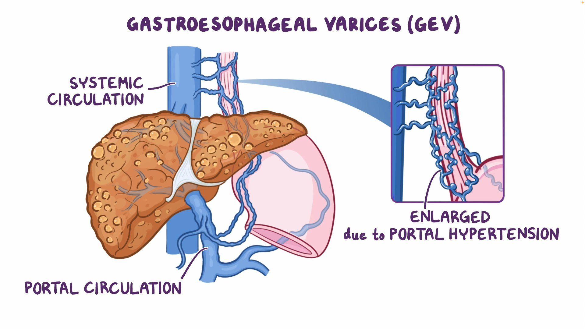 Gastroesophageal varices: Clinical sciences - Osmosis Video Library