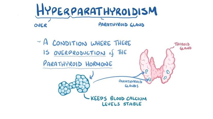 Hyperparathyroidism: Video, Anatomy & Definition | Osmosis