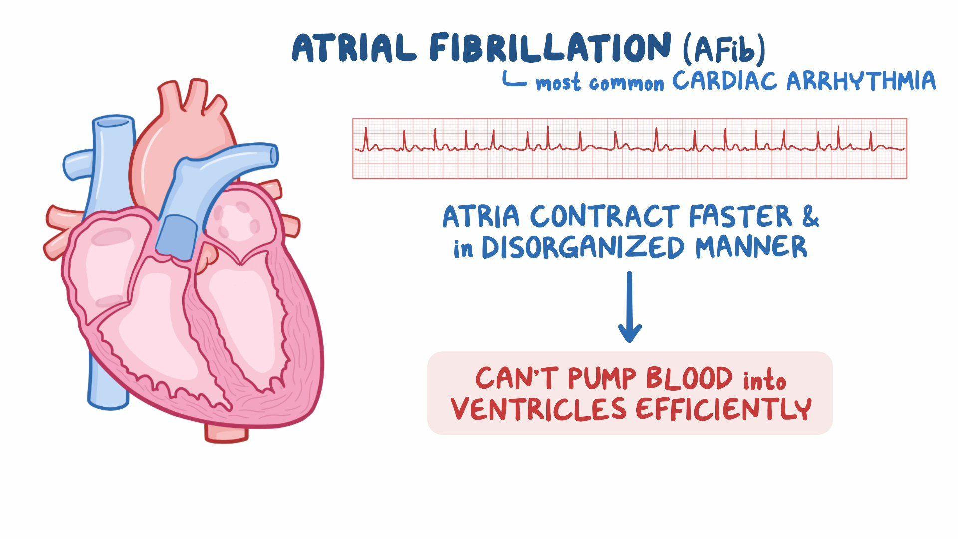 Arrhythmias - Atrial fibrillation (Afib): Nursing - Osmosis Video Library