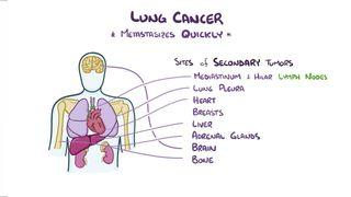 CAUTION UP: Cancer Warning Signs Mnemonic | Osmosis