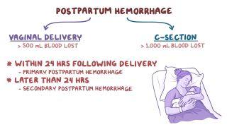 Uterine Atony: What Is It, Risk Factors, Treatment | Osmosis