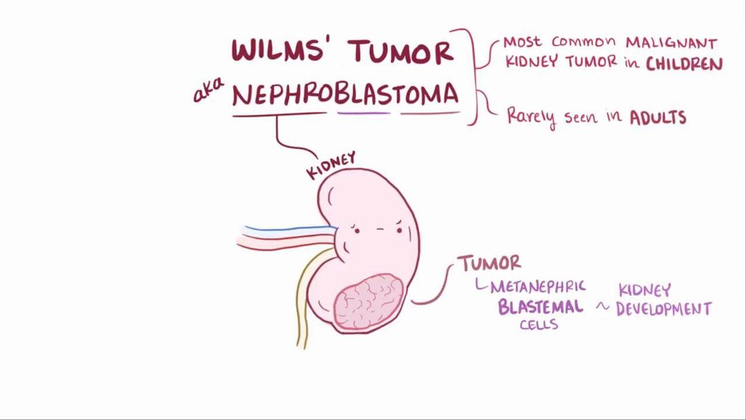 Nephroblastoma (Wilms tumor): Video & Anatomy | Osmosis