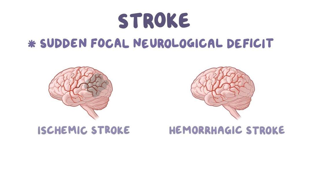 Stroke: Clinical: Video, Anatomy, Definition & Function | Osmosis