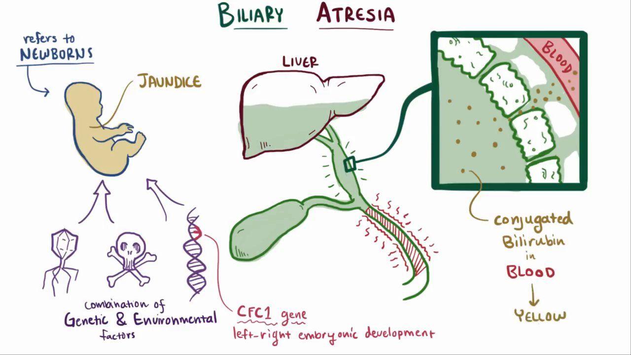 Biliary atresia: Video, Anatomy, Definition & Function | Osmosis
