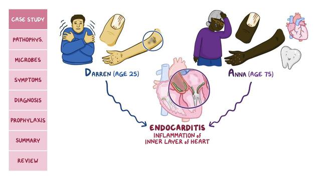 Endocarditis: Pathology review: Video & Anatomy | Osmosis