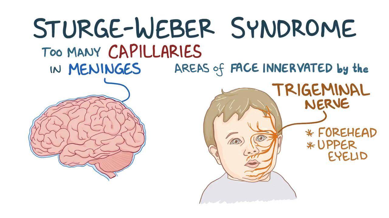 Sturge-Weber syndrome: Video, Anatomy & Definition | Osmosis