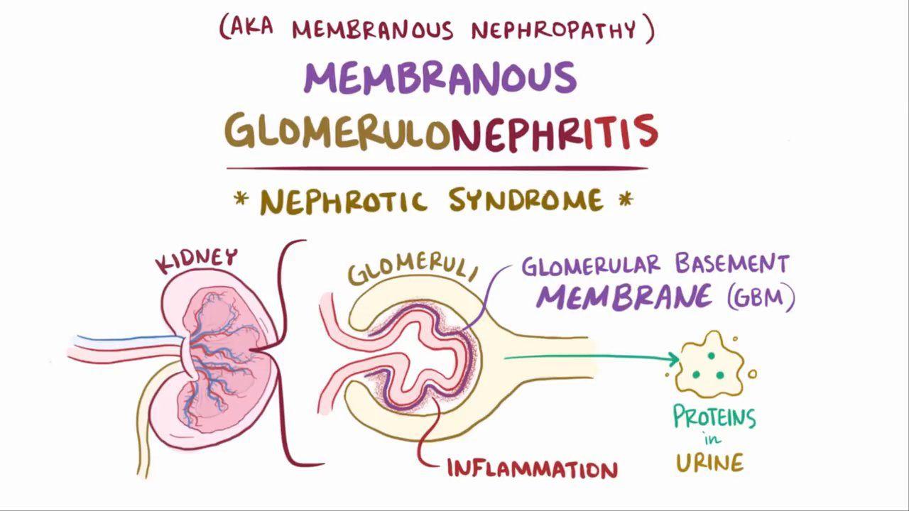 Membranous nephropathy: Video, Anatomy & Definition | Osmosis