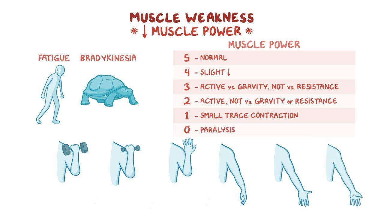 Muscle weakness: Clinical: Video, Anatomy & Definition | Osmosis